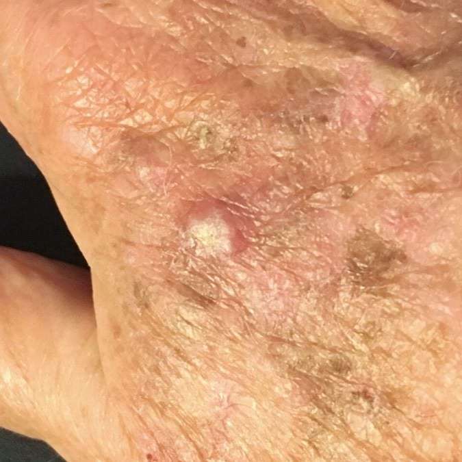 Actinic Keratosis Actinic Keratosis Information | Mount Sinai New